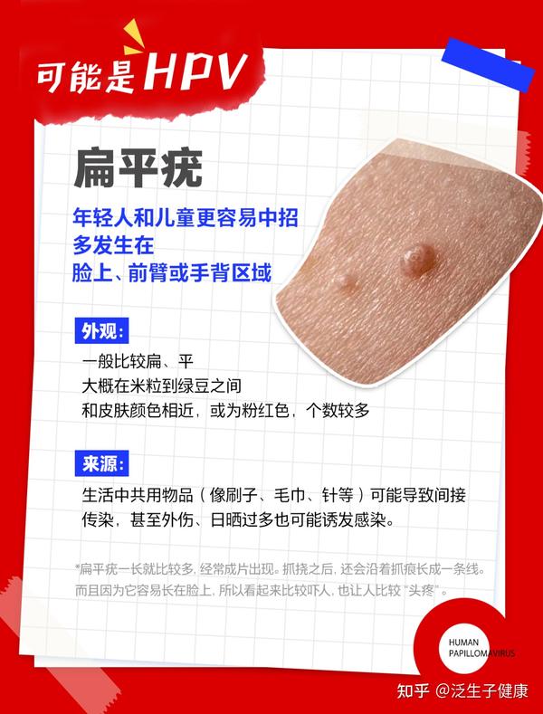 男人也会感染！身上若出现这4种小疙瘩，十有八九HPV已经来了 - 知乎
