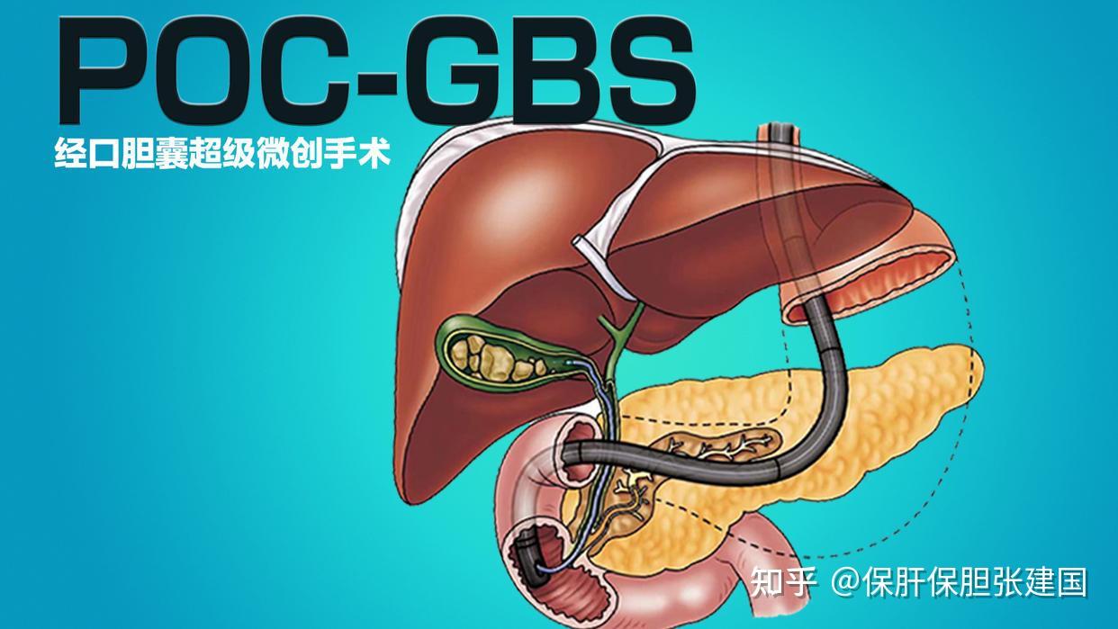经口胆囊超级微创保胆取石手术和Ercp技术有哪些区别？ - 知乎