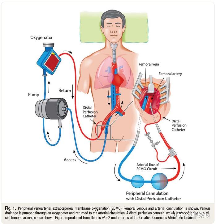 你放心把生命交给体外膜肺氧合术（ECMO）吗？ - 知乎