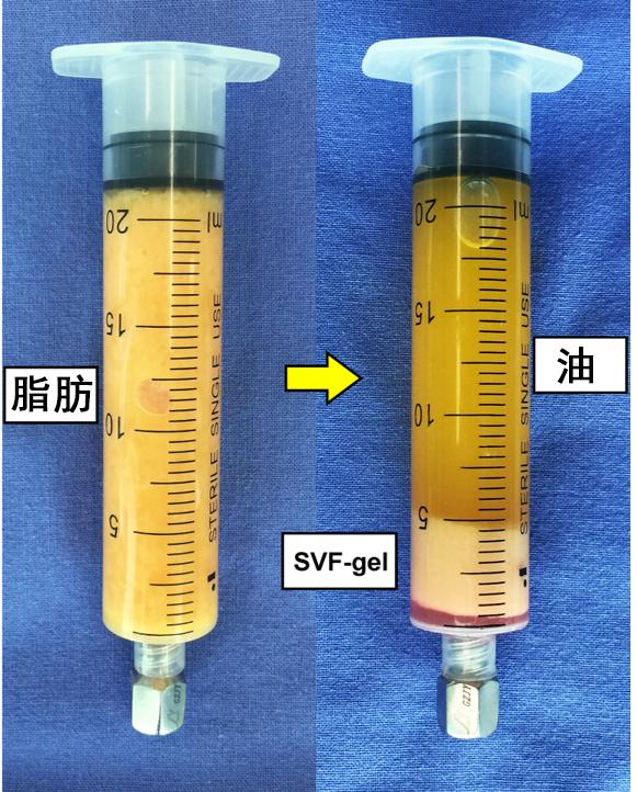 脂肪干细胞胶SVF-gel与面部年轻化 - 知乎