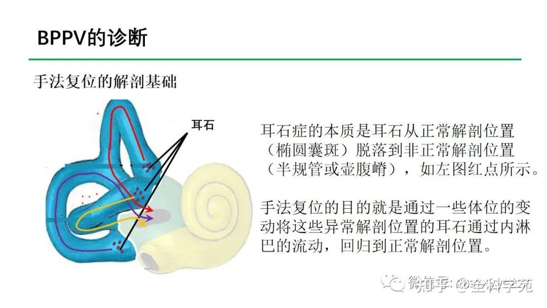 良性阵发性位置性眩晕 BPPV 最全整理 - 知乎