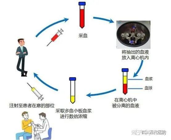 什么是PRP？PRP治疗有什么优势？ - 知乎