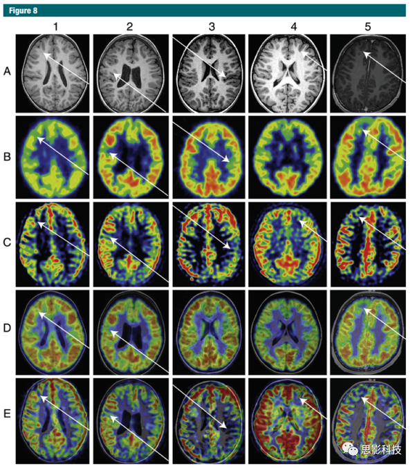 Radiology：大脑动脉自旋标记（ASL)灌注方法介绍 - 知乎