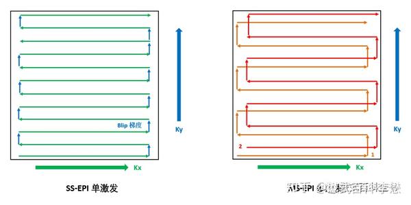 IRIS：多激发SE-EPI扩散（弥散）序列 - 知乎