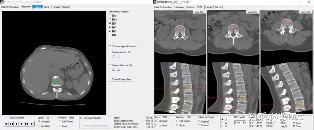 定量CT（QCT）是什么？临床应用有哪些？ - 知乎