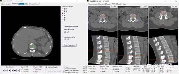 定量CT（QCT）是什么？临床应用有哪些？ - 知乎