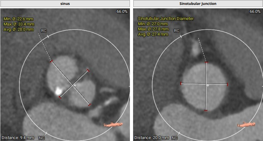 中南大学湘雅医院罗凡砚教授团队成功为两位“80后”高龄高危二叶畸形主动脉瓣重度狭窄患者行TAVR手术 - 知乎