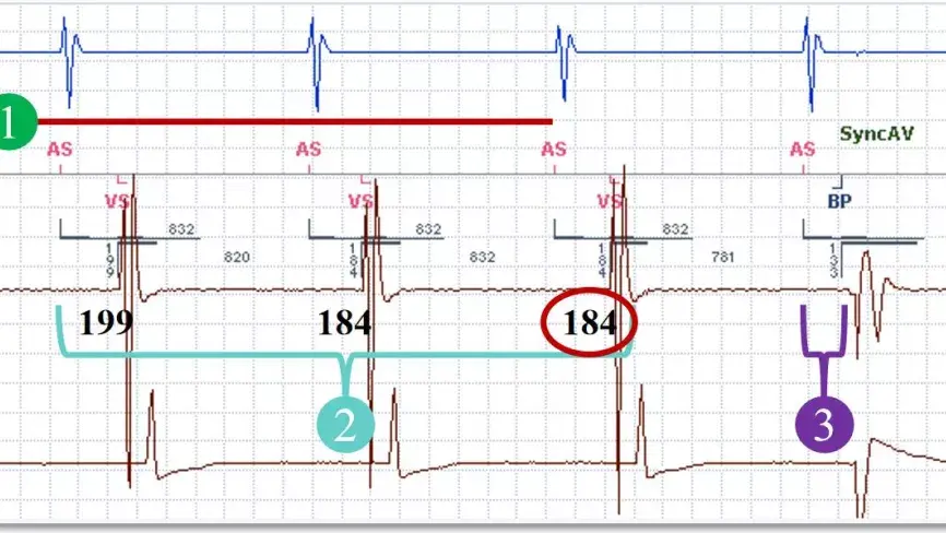 科研资讯 | 上海长海医院赵仙先团队 | 评价SyncAV算法对心脏超声指标和临床心功能的影响 - 知乎