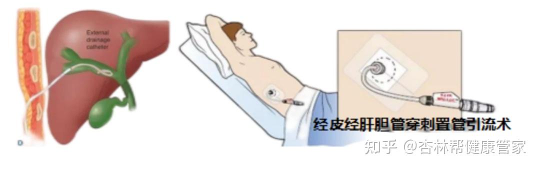 经皮肝穿刺胆道引流术的科普 - 知乎