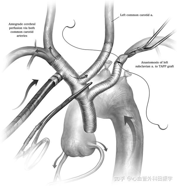 “分支优先”的主动脉弓置换术 - 知乎