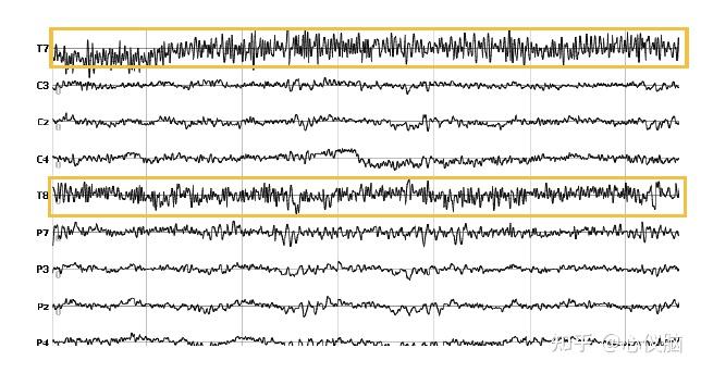 你知道EEG信号采集中的伪迹都有哪些吗？ - 知乎
