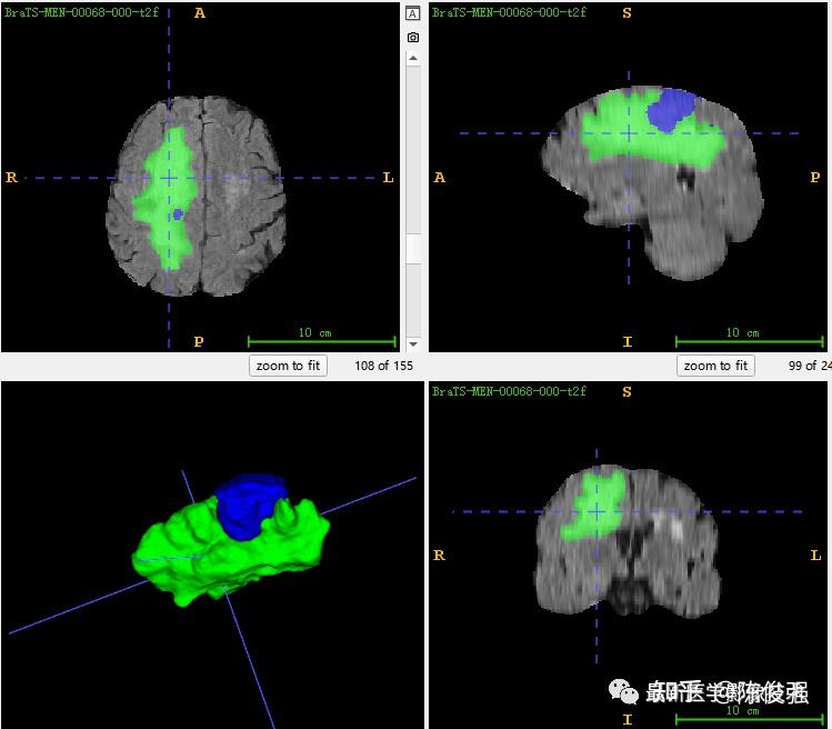 BraTS2023-MEN——BraTS2023颅内脑膜瘤分割挑战赛 - 知乎