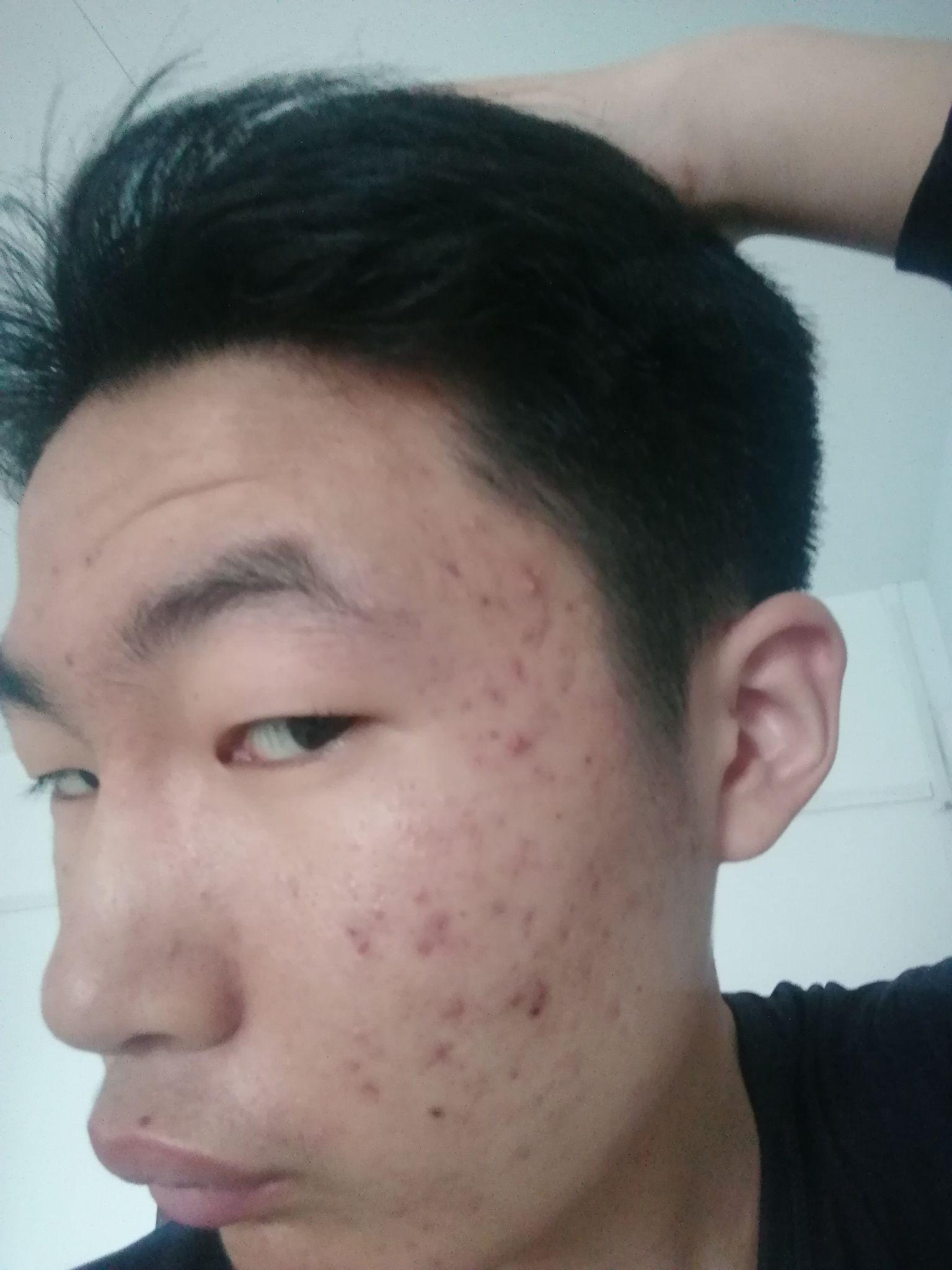 痘痘 知乎