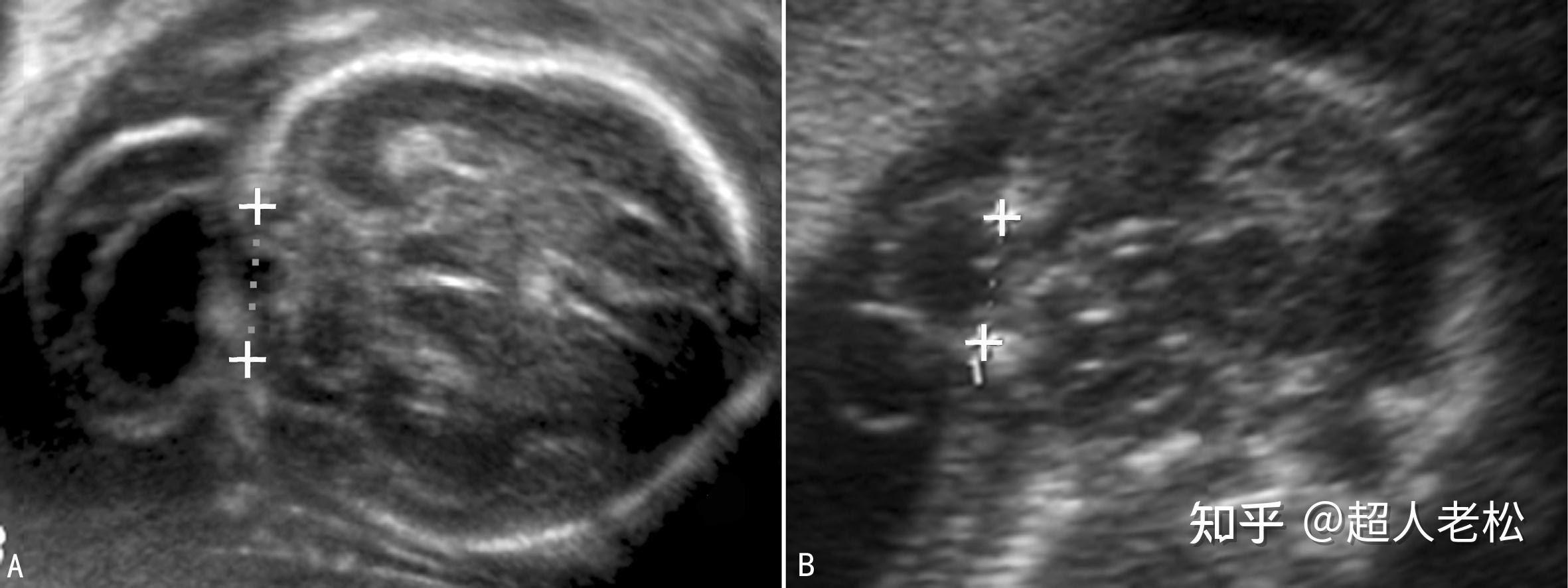 明明白白做超声25-9：胎儿神经管缺陷—脑膨出 - 知乎