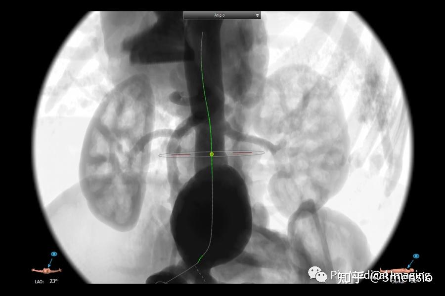 3mensio vascular - 知乎