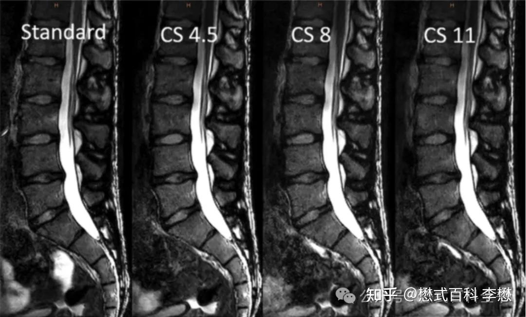 一文了解MRI图像重建的前沿趋势：从CS到深度学习 - 知乎