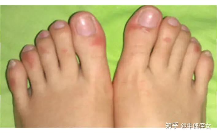 甲沟炎应该去医院还是去修脚店,让你痛不欲生的甲沟炎怎么才能根治? 知乎