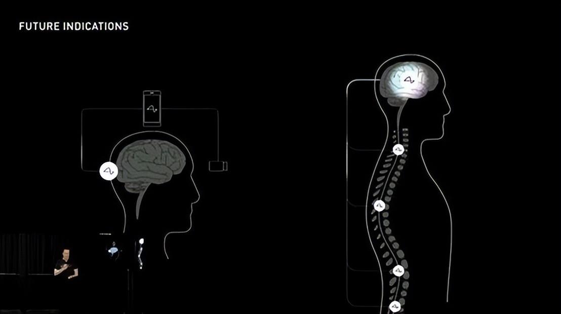 【长期主义】第194期科技说：Neuralink最新技术展示，猴子用意念打字，预计最快6个月内进行人体试验 - 知乎