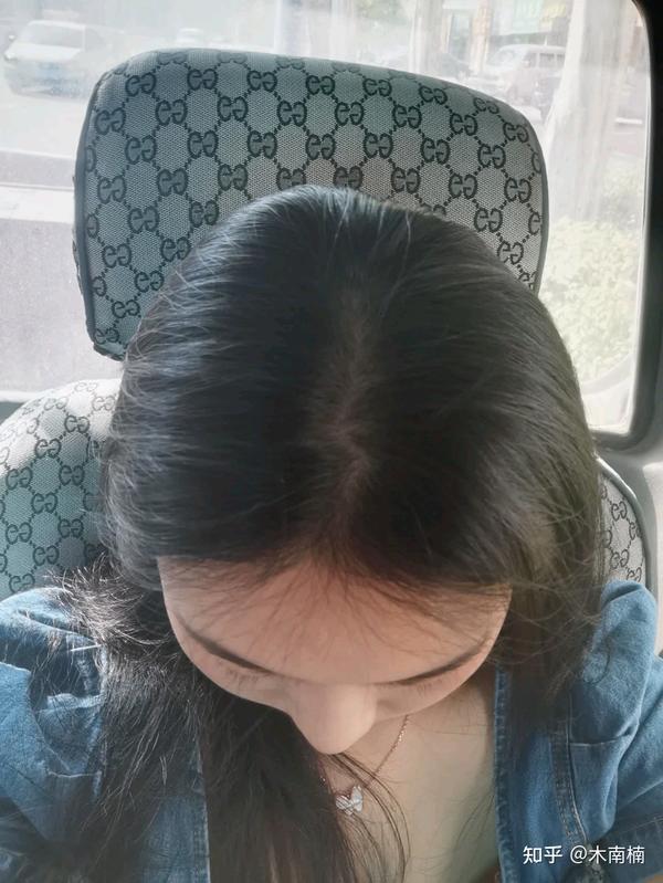 不染发，有什么靠谱的改善白头发的办法吗白头发怎么才能改善好？ 知乎