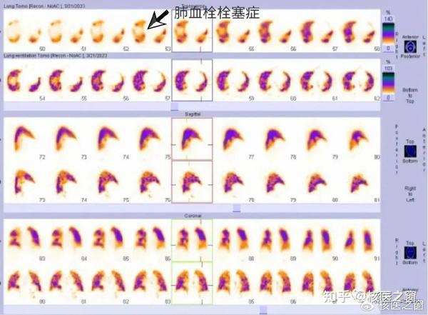 SPECT/CT临床应用 - 知乎