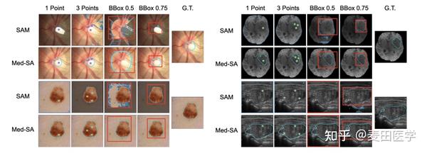 文献速递：基于SAM的医学图像分割---医疗 SAM 适配器：适配用于医学图像分割的 Segment Anything 模型 - 知乎
