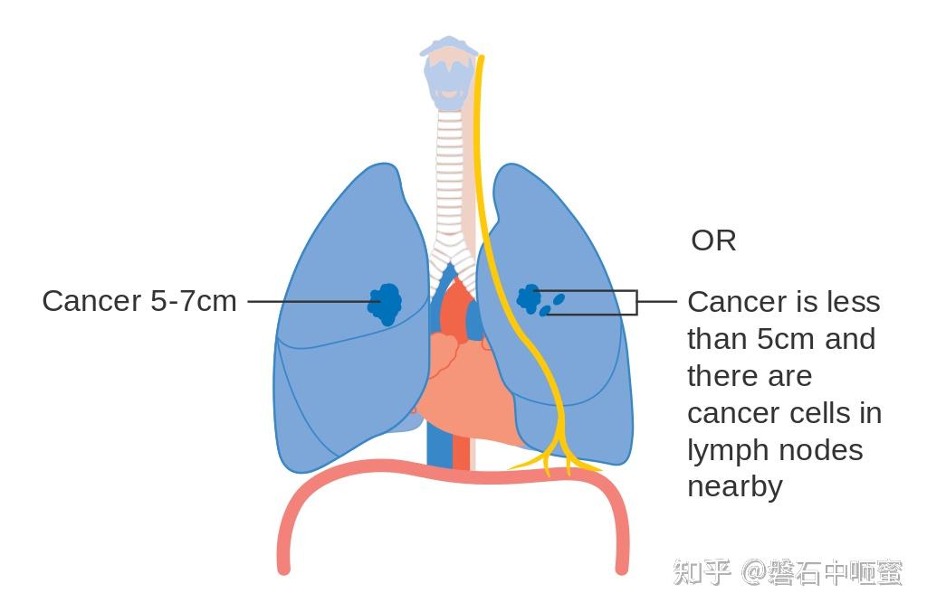肺癌 Lung cancer - 知乎