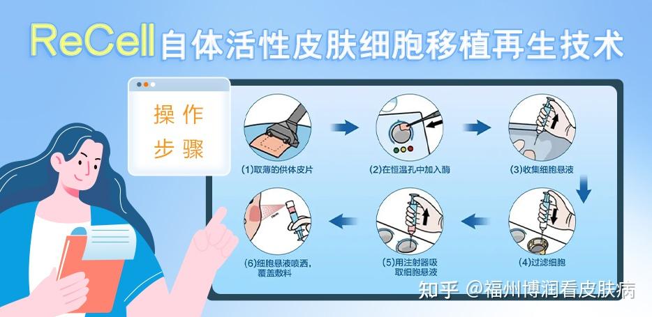 【博润革新】福建白癜风医院ReCell技术，引领白癜风治疗新潮流！ - 知乎