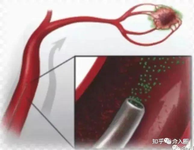 一文了解肿瘤介入治疗 - 知乎