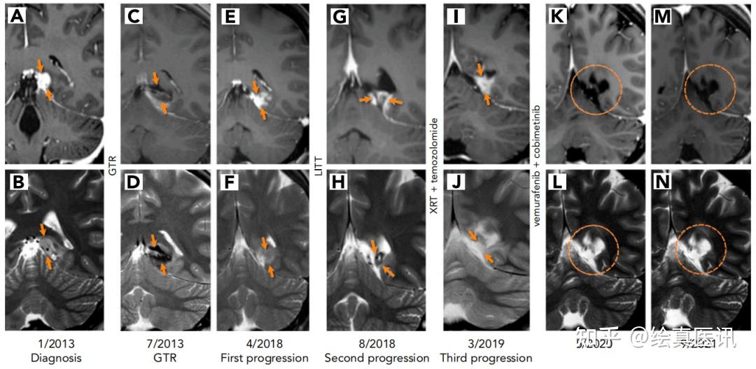 BRAF突变多形性黄色星形细胞瘤选择BRAF/MEK双抑制剂获益更佳？【IF=9.316】 - 知乎
