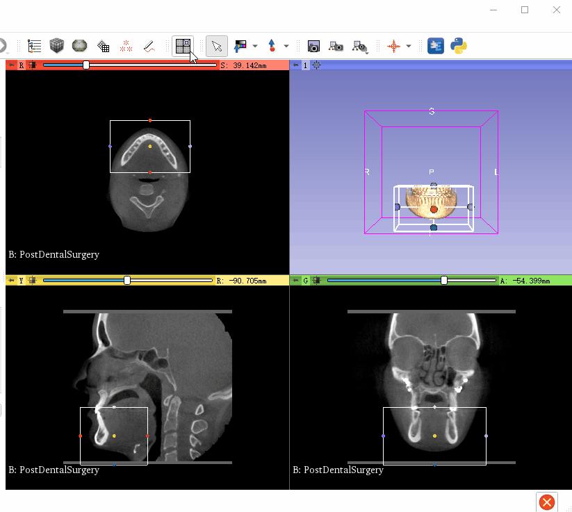 3D Slicer——选择感兴趣区，输出为DICOM序列 - 知乎