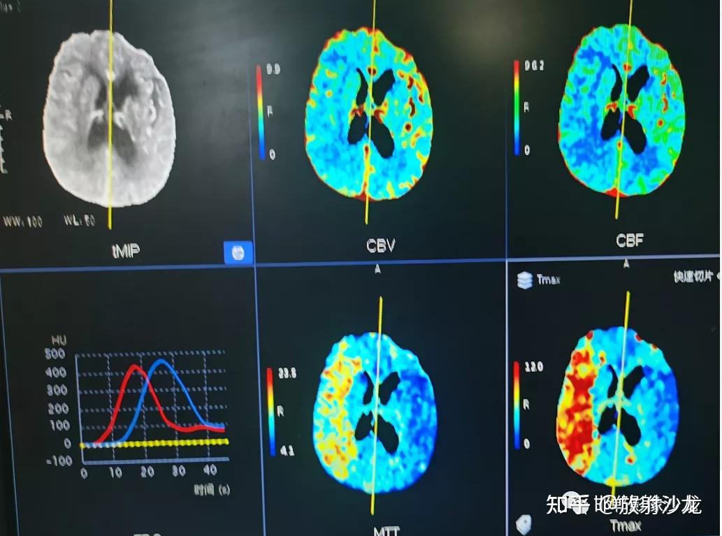 CTP在急性缺血性脑血管病应用病例分享 - 知乎