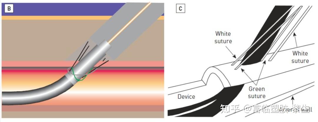 血管闭合：可以分为有源设备和无源设备 - 知乎