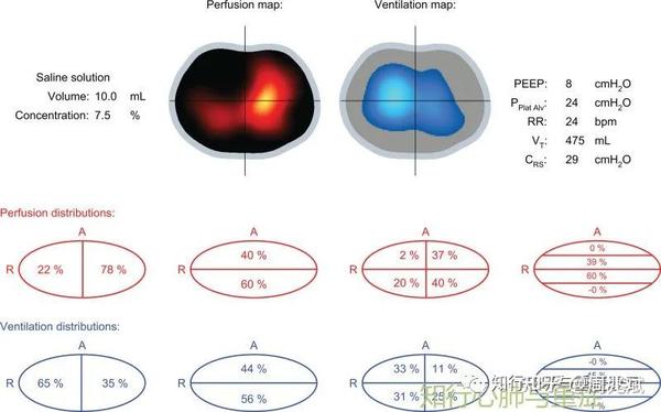 第139期胸部电阻抗断层成像（EIT）的原理、图像分析及临床应用 - 知乎