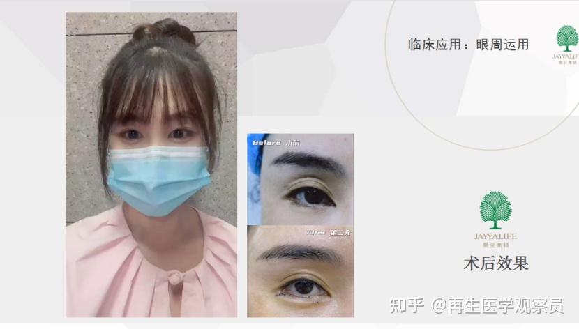 卧蚕盈之，巧笑嫣嫣 —ADM-H卧蚕术让美丽不“透光” - 知乎