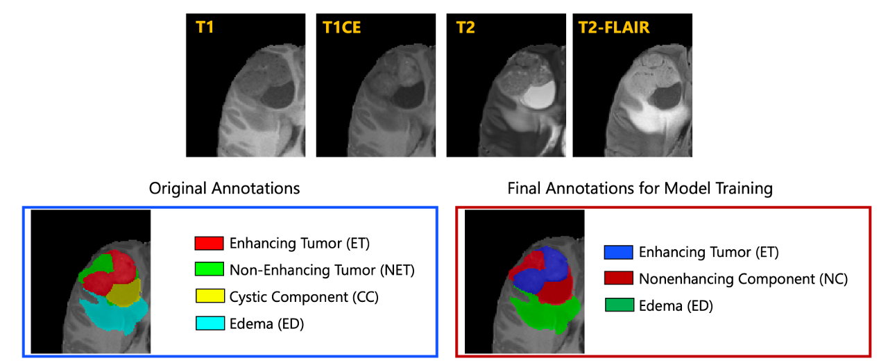 BraTS2023-PED 数据集介绍 - 知乎
