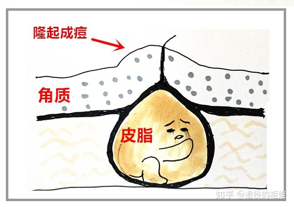 粉刺有哪些类型？常说的黑头粉刺、闭口粉刺、青春痘都有什么区别？ 知乎