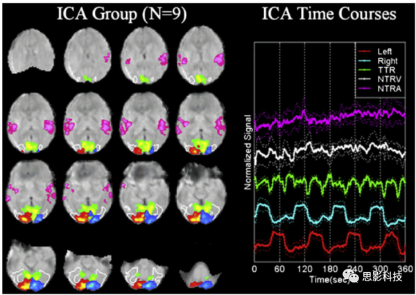 ICA在fMRI组水平推断和融合多模态数据方面的应用 - 知乎