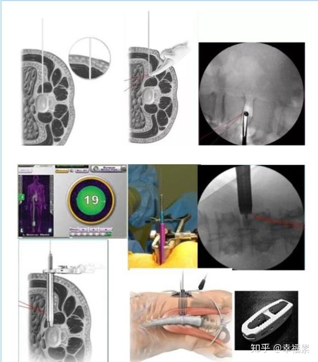 UBE 这些差别你知道吗？PLF PLIF TLIF DLIF XLIF 手术技术对比【医术苑】科普 - 知乎