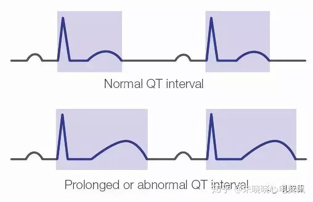 『正确』测量QT/QTc间期 - 知乎