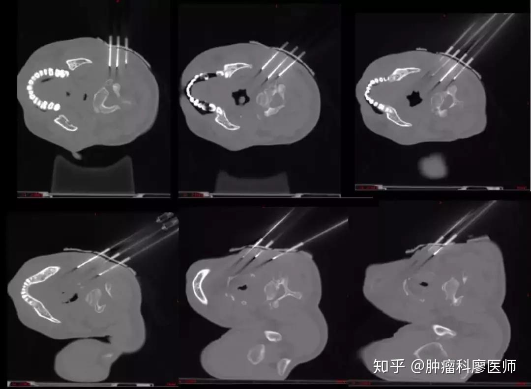 肿瘤热疗联合粒子植入让癌细胞缴械投降！ 知乎 4158
