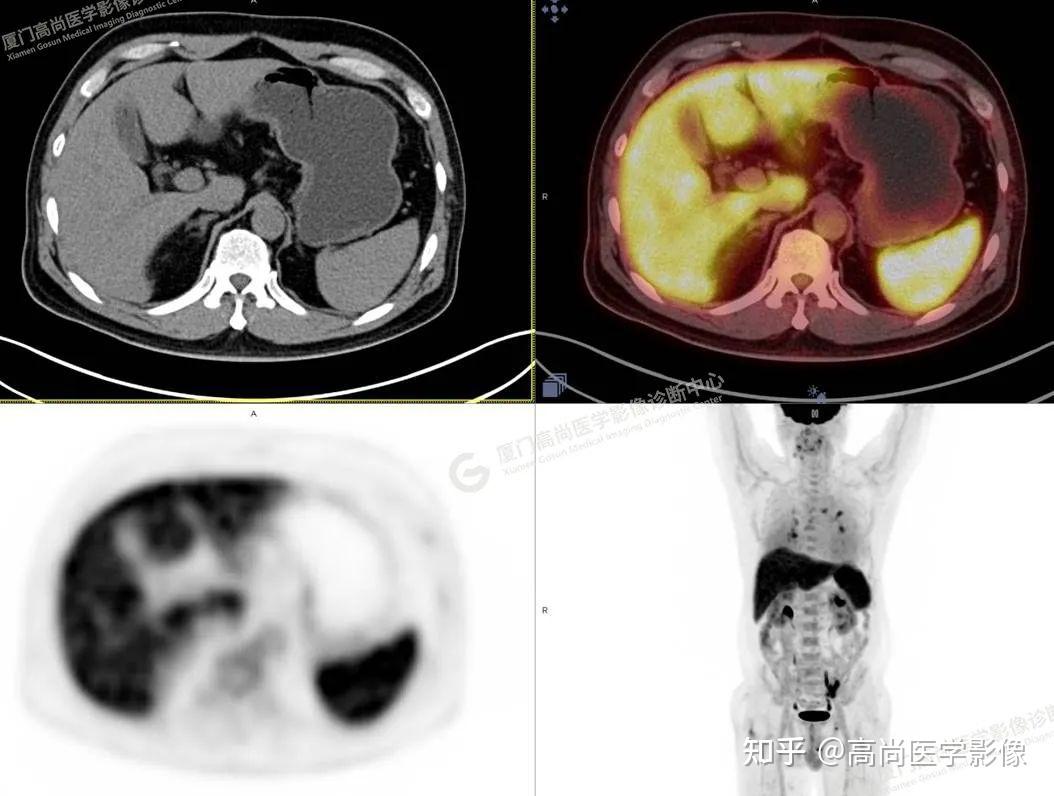 18F-FDG PET/CT诊断多脏器结核病例分享【高尚医学影像】 - 知乎