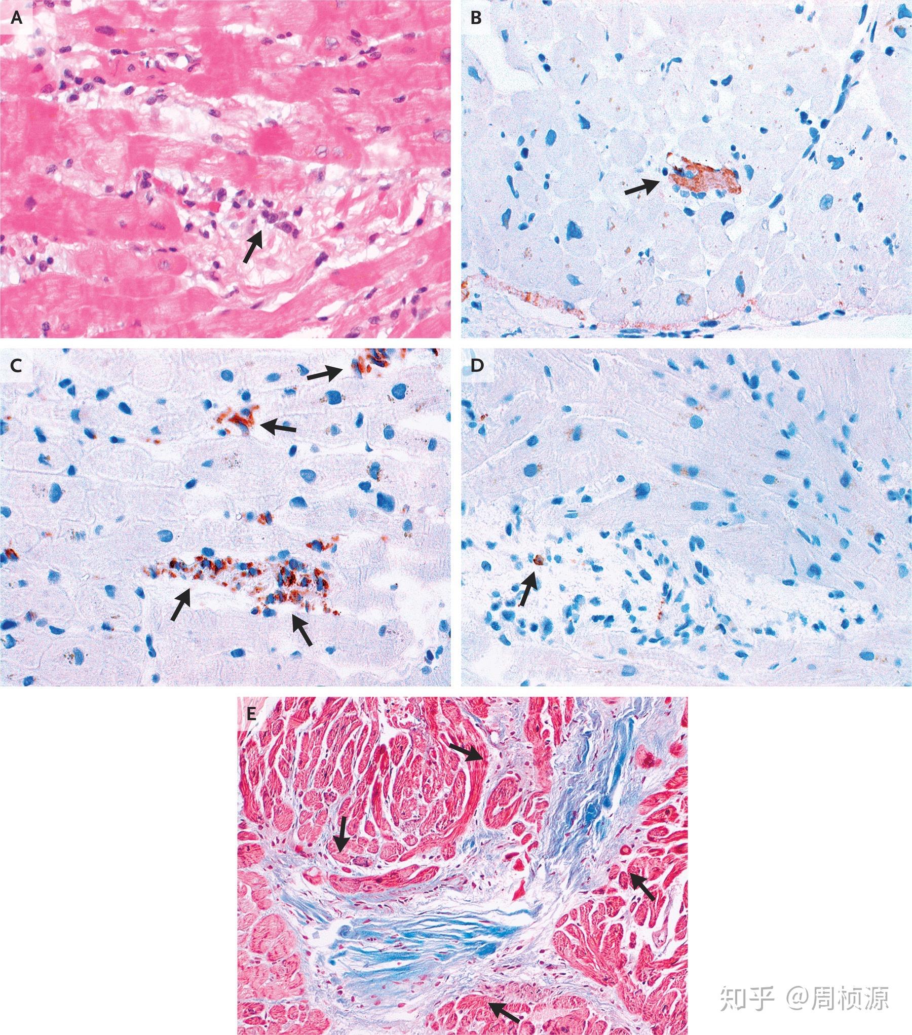 nejm 2018 case 8 - 知乎