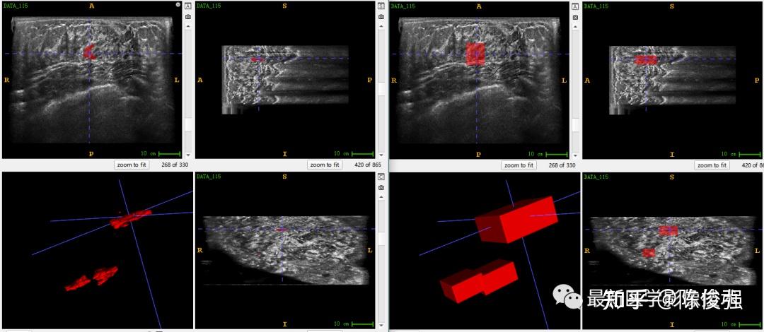 TDSC-ABUS2023——2023年自动化3D乳腺超声 (ABUS) 的肿瘤检测、分割和分类挑战验证集结果 - 知乎