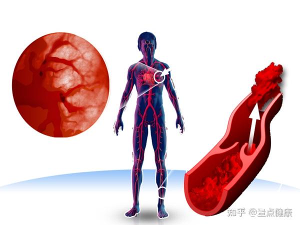 骨科 | VTE快速筛查与长期监测的重要性 - 知乎