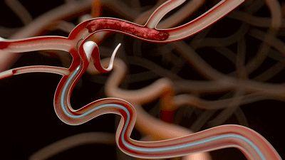 超大口径抽吸导管获FDA批准上市！ - 知乎