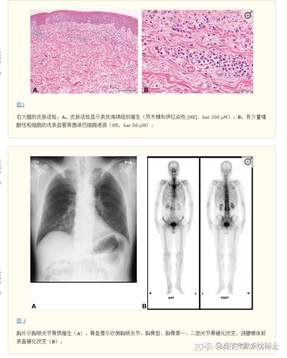 首例SAPHO综合征合并丘疹红皮病的病例报告！ - 知乎