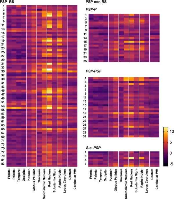 EJNMMI：PET成像显示PSP中tau病理分布模式和脑区易感性 - 知乎