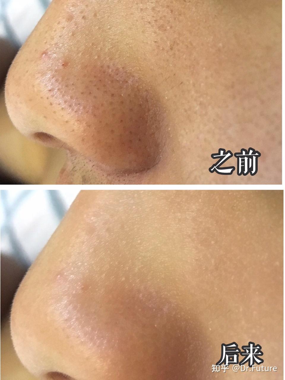 推荐几款好一点的去黑头产品? 知乎