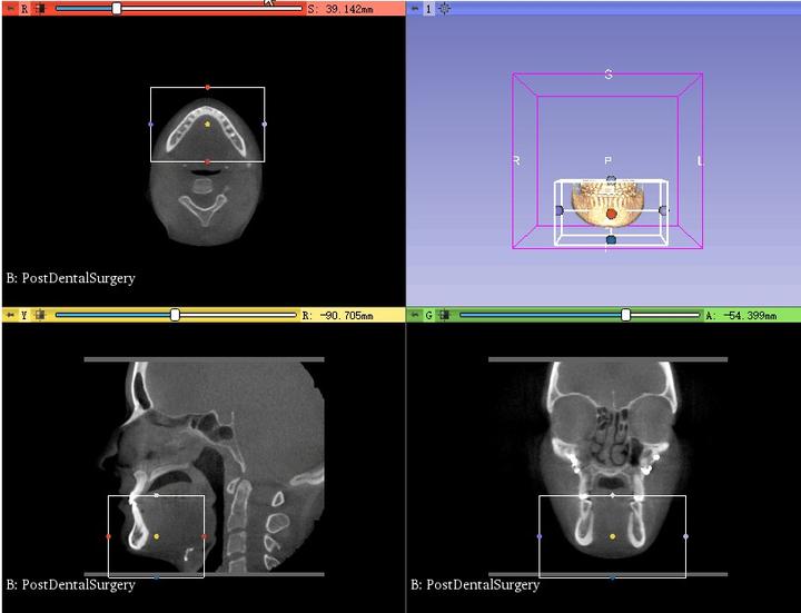 3D Slicer——选择感兴趣区，输出为DICOM序列 - 知乎