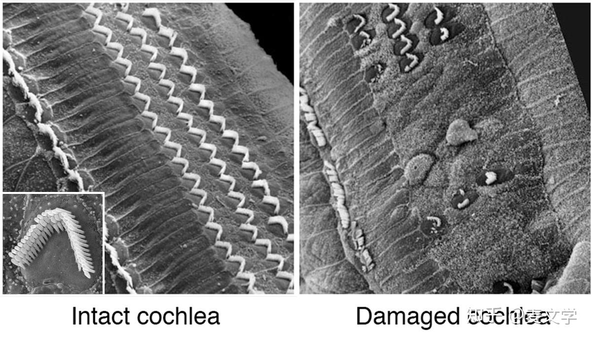 春节后遗症之爆震聋:内耳声损伤性耳聋NIHL noise induced hearing loss - 知乎